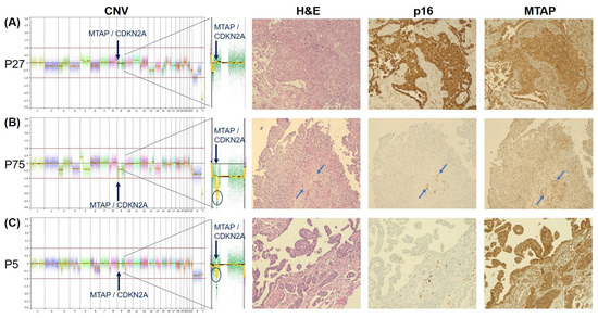 Deletions of CDKN2A and MTAP Detected by Copy-Number Variation Array Are Associated with Loss of ...
