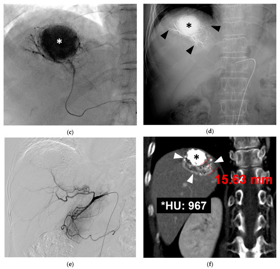 Local Recurrence following Radiological Complete Response in Patients ...