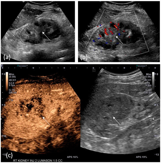 Imaging in Upper Tract Urothelial Carcinoma: A Review
