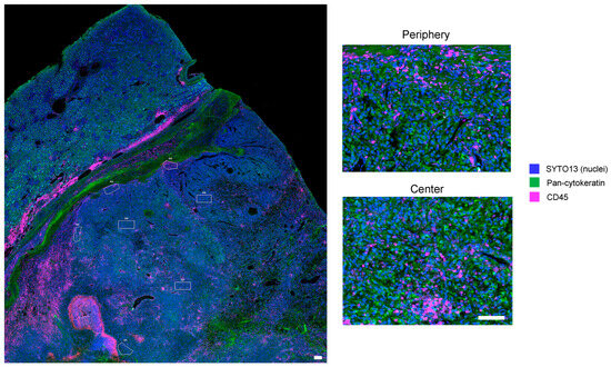 Cancers | Free Full-Text | Digital Spatial Profiling Identifies the ...
