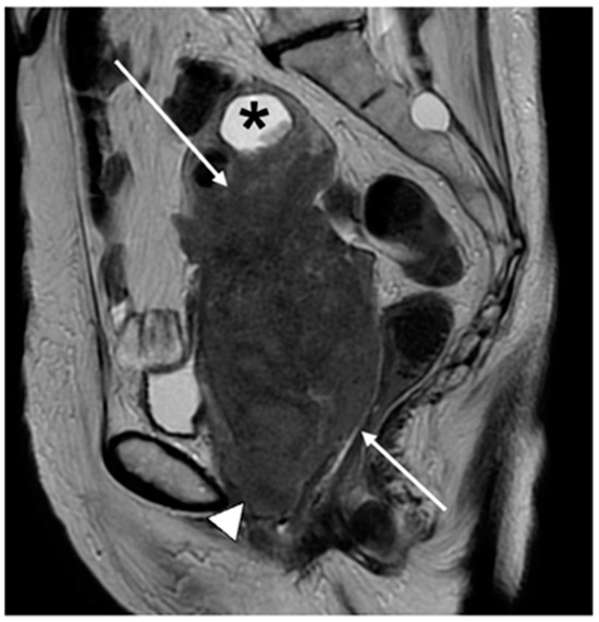 An Update on the Role of MRI in Treatment Stratification of Patients ...