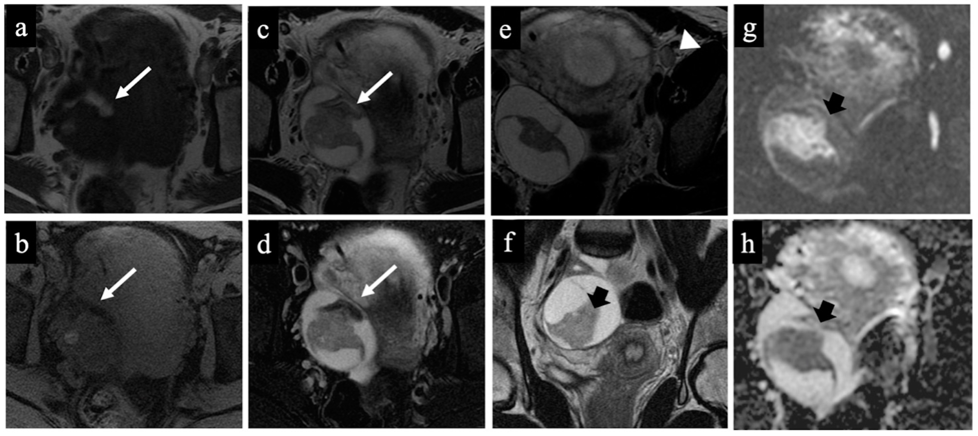 Cancers | Free Full-Text | Prediction of the Risk of Malignancy of Adnexal Masses during ...