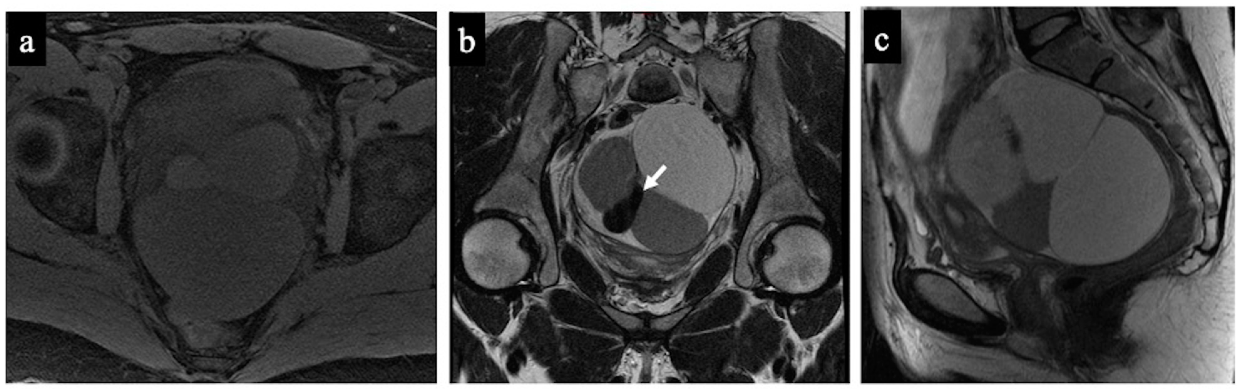 Cancers | Free Full-Text | Prediction of the Risk of Malignancy of Adnexal Masses during ...