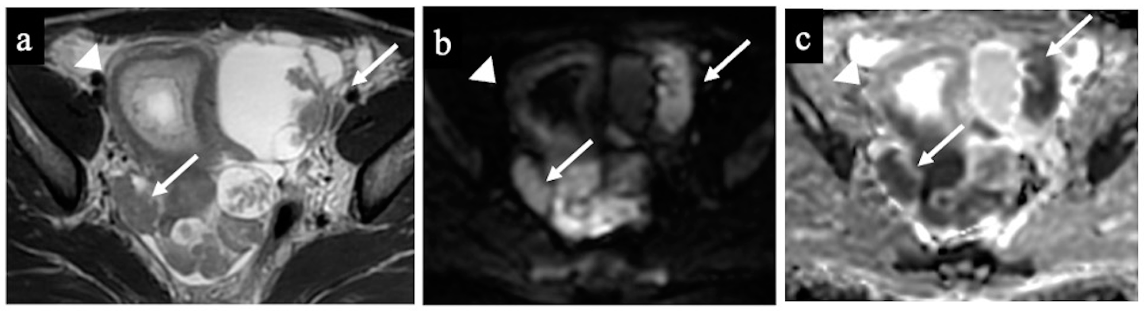 Cancers | Free Full-Text | Prediction of the Risk of Malignancy of Adnexal Masses during ...