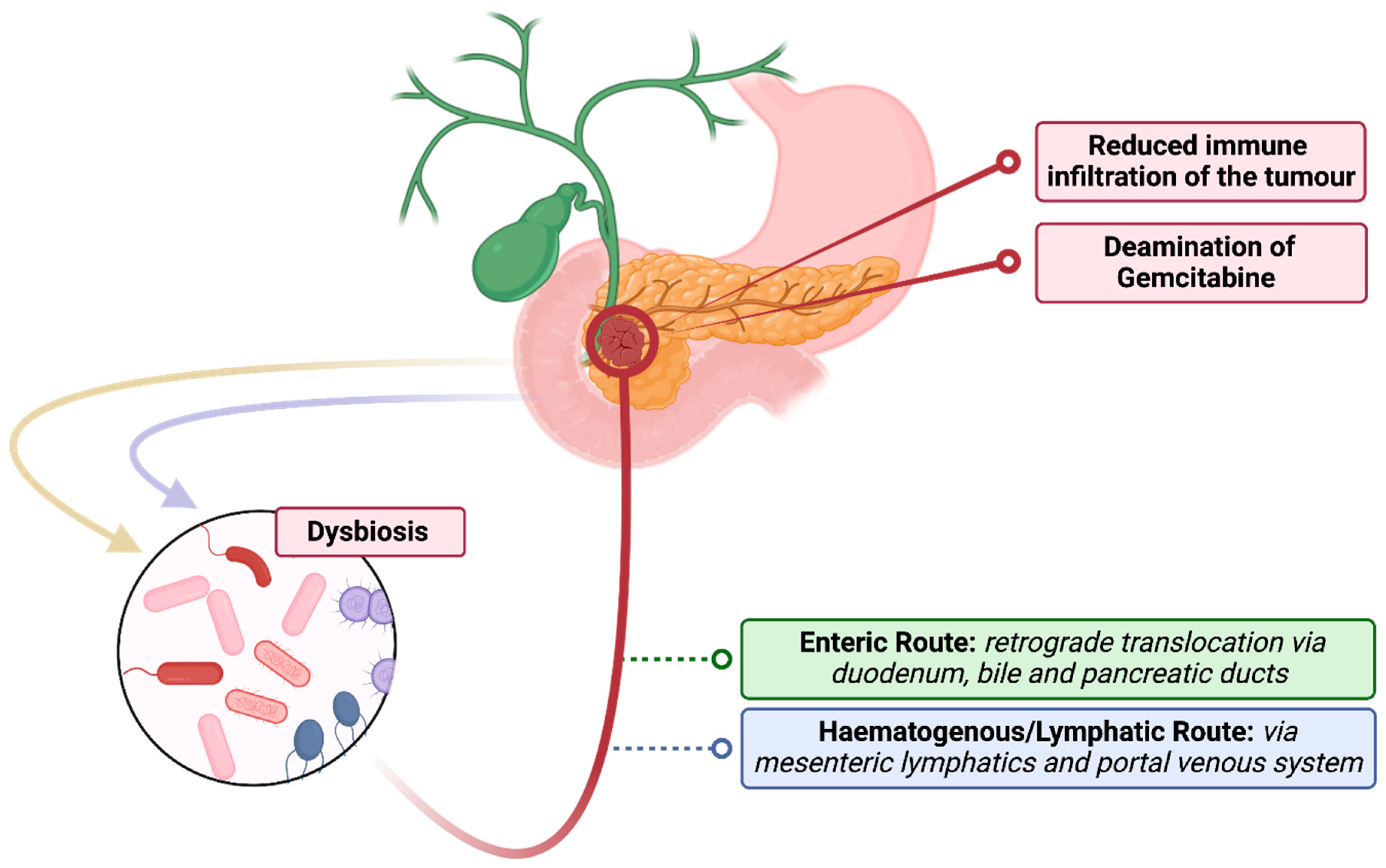 Pancreatic Exocrine Insufficiency and the Gut Microbiome in Pancreatic ...