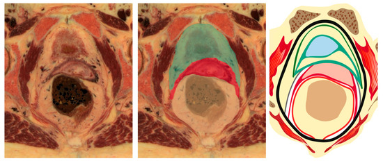 Cancers | Free Full-Text | Radical Hysterectomy or Total Mesometrial ...
