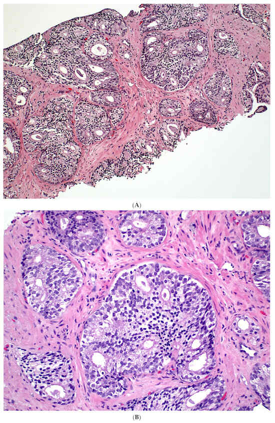 Intraductal Carcinoma of the Prostate: To Grade or Not to Grade