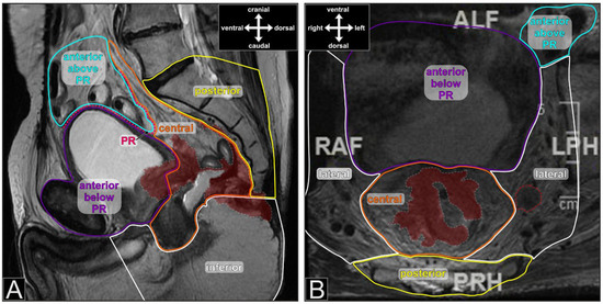 Beyond Total Mesorectal Excision (TME)—Results of MRI-Guided Multivisceral Resections in T4 ...