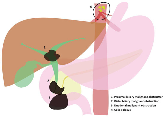 The Role of Endoscopy in the Palliation of Pancreatico-Biliary Cancers ...