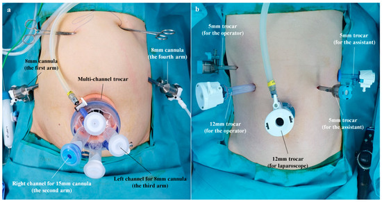 Trans-Umbilical Lymphadenectomy Using an Articulating Bipolar Vessel ...