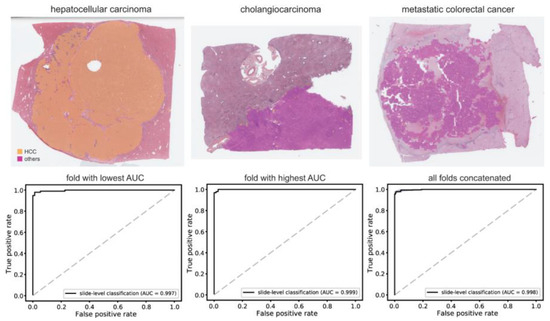 Deep Learning for the Pathologic Diagnosis of Hepatocellular Carcinoma ...