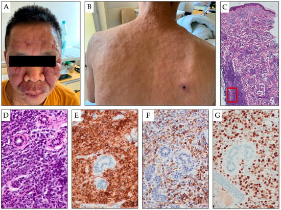 Leukemia Cutis—The Current View on Pathogenesis, Diagnosis, and Treatment