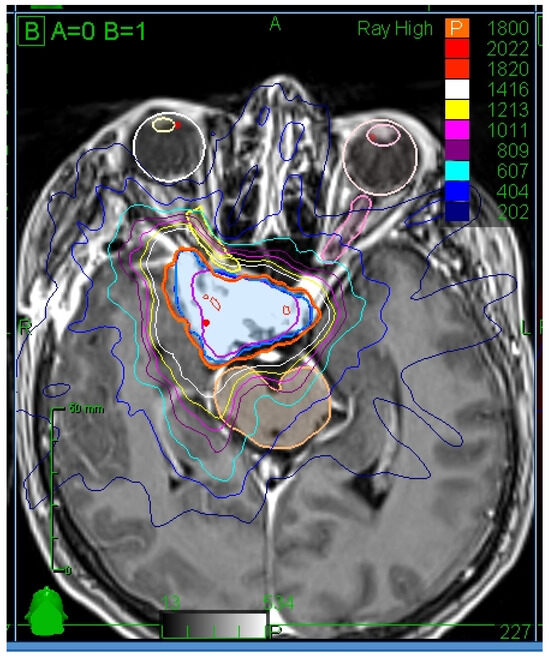 Robotic Stereotactic Radiotherapy for Intracranial Meningiomas—An ...
