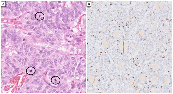 Lung Carcinoids: A Comprehensive Review for Clinicians