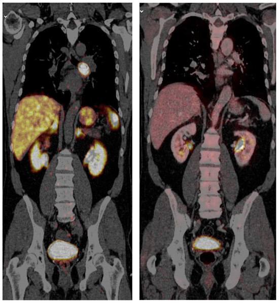Lung Carcinoids: A Comprehensive Review for Clinicians