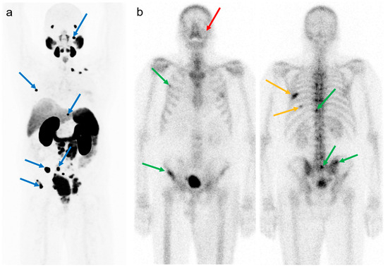 Cancers | Free Full-Text | Can We Predict Skeletal Lesion on Bone Scan ...