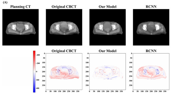 CBCT-to-CT Synthesis for Cervical Cancer Adaptive Radiotherapy via U ...