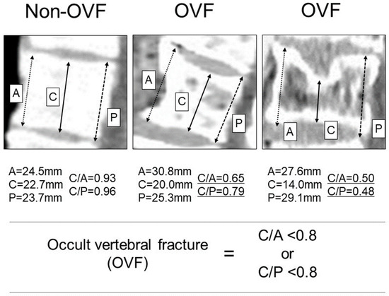 Cancers | Free Full-Text | Occult Vertebral Fracture (OVF) in Patients ...