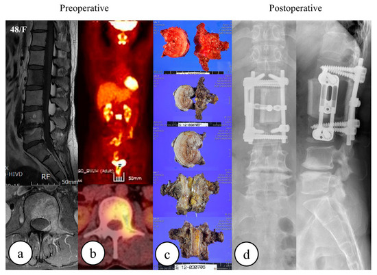 Cancers | Free Full-Text | Efficacy of Total En Bloc Spondylectomy versus Stereotactic Ablative ...