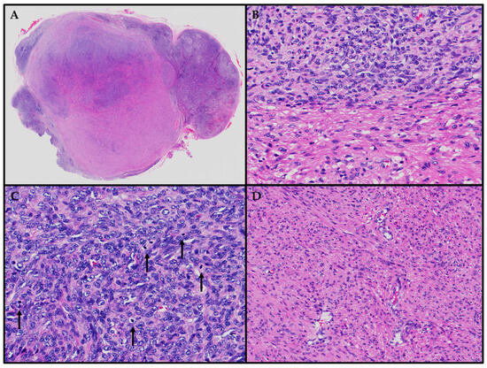 A Clinicopathology Review and Update of Epstein–Barr Virus-Associated ...