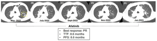 Cancers | Free Full-Text | Real-World Treatment Outcomes and Safety of ...