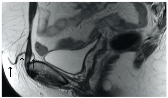 Urethral Mesh Assessment in Cancer Patients