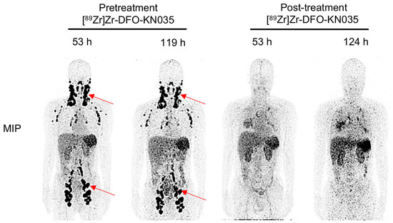 Clinical Application of ImmunoPET Targeting Checkpoint Inhibitors