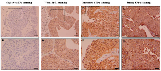Identification of SPP1 as a Prognostic Biomarker and Immune Cells ...