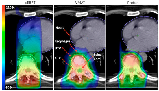 Dosimetric Comparison of Conventional Radiotherapy, Volumetric ...