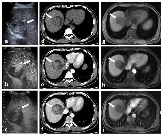 Cancers | Free Full-Text | Complementary Role of CEUS and CT/MR LI-RADS ...