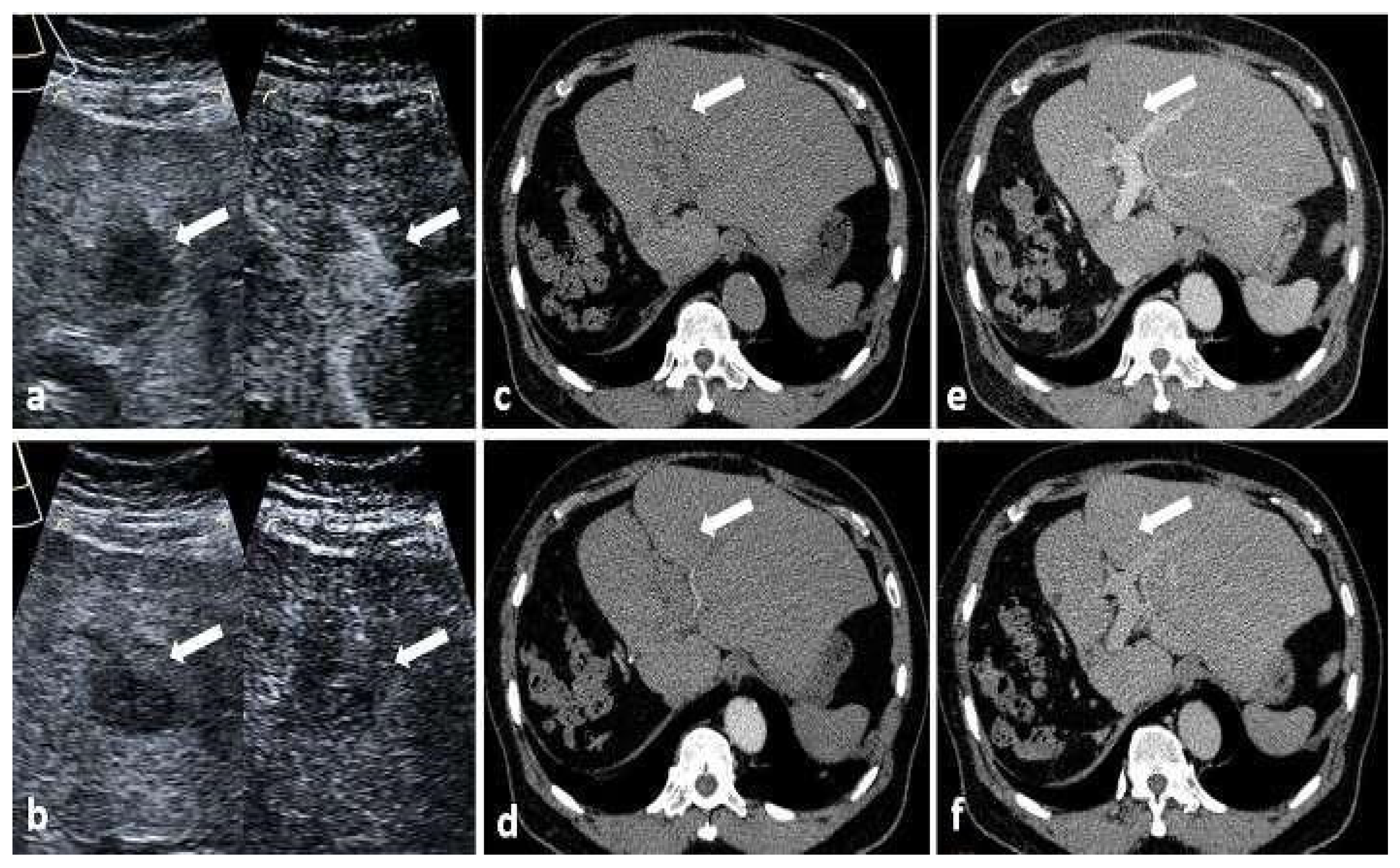 Cancers | Free Full-Text | Complementary Role of CEUS and CT/MR LI-RADS ...