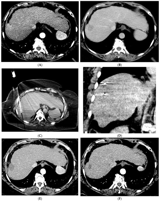 New Insights on Liver-Directed Therapies in Hepatocellular Carcinoma