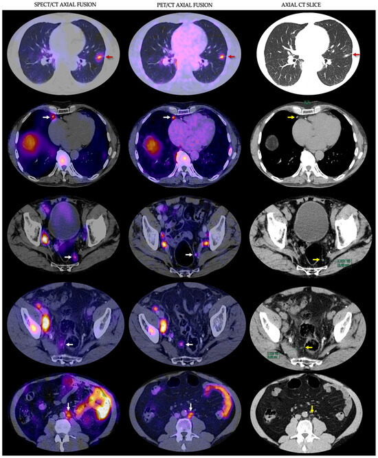 Diagnostic Performance of 99mTc-iPSMA SPECT/CT in the Initial Staging of Patients with ...