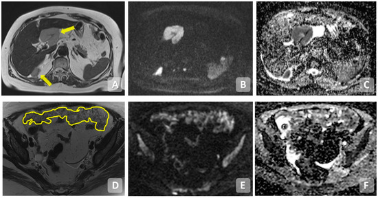 Imaging of Peritoneal Carcinomatosis in Advanced Ovarian Cancer: CT ...