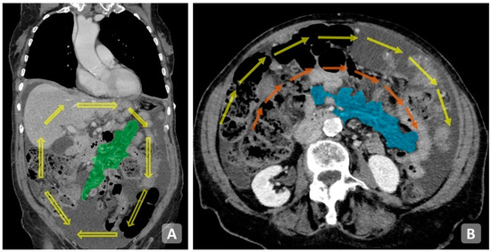 Imaging of Peritoneal Carcinomatosis in Advanced Ovarian Cancer: CT ...