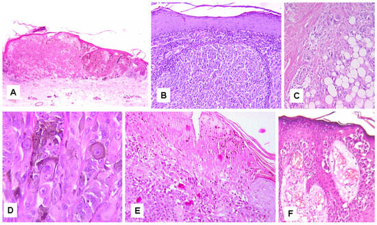 Spitz Tumors and Melanoma in the Genomic Age: A Retrospective Look at ...
