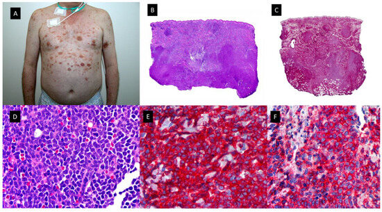 Cancers | Free Full-Text | Clinical, Histopathological and Molecular ...