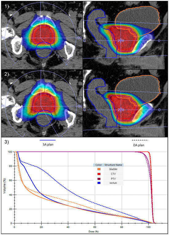 Cancers | Free Full-Text | Treatment Optimization in Linac-Based SBRT ...