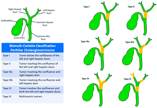 Multi-Disciplinary Care of Hilar Cholangiocarcinoma: Review of Guidelines and Recent Advancements