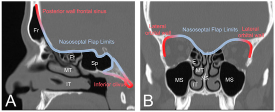 Reconstruction of the Anterior Skull Base Using the Nasoseptal Flap: A ...
