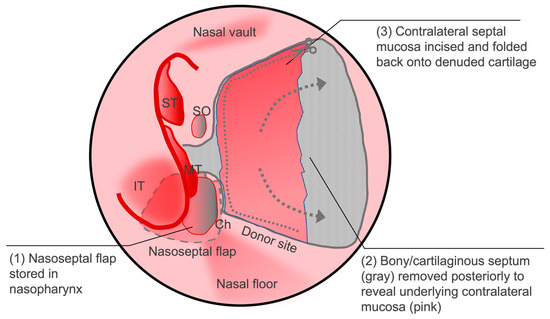 Reconstruction of the Anterior Skull Base Using the Nasoseptal Flap: A Review