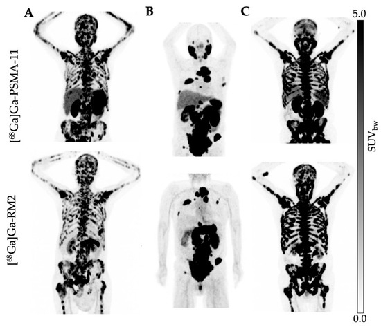 Imaging GRPr Expression in Metastatic Castration-Resistant Prostate ...