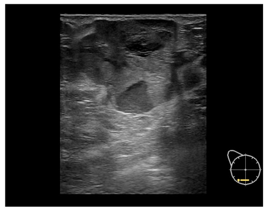 Discrepancy between Tumor Size Assessed by Full-Field Digital ...