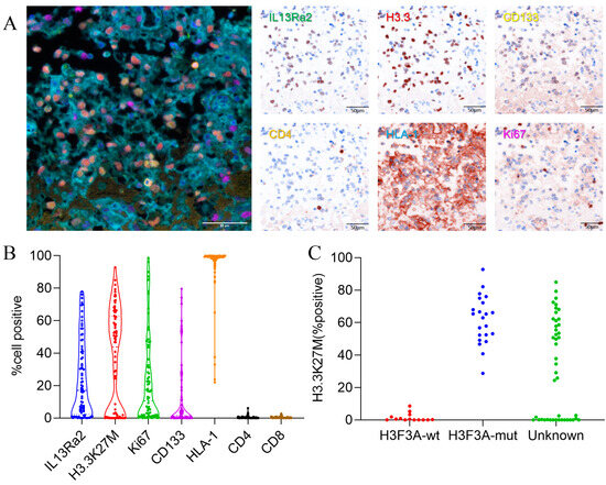 Expression of Interleukin-13 Receptor Alpha 2 in Brainstem Gliomas