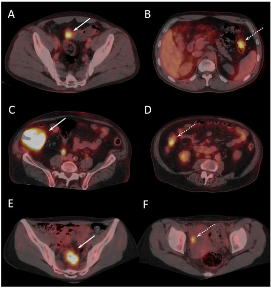 Preoperative 18F-FDG PET/CT in Patients with Presumed Localized Colon Cancer: A Prospective ...