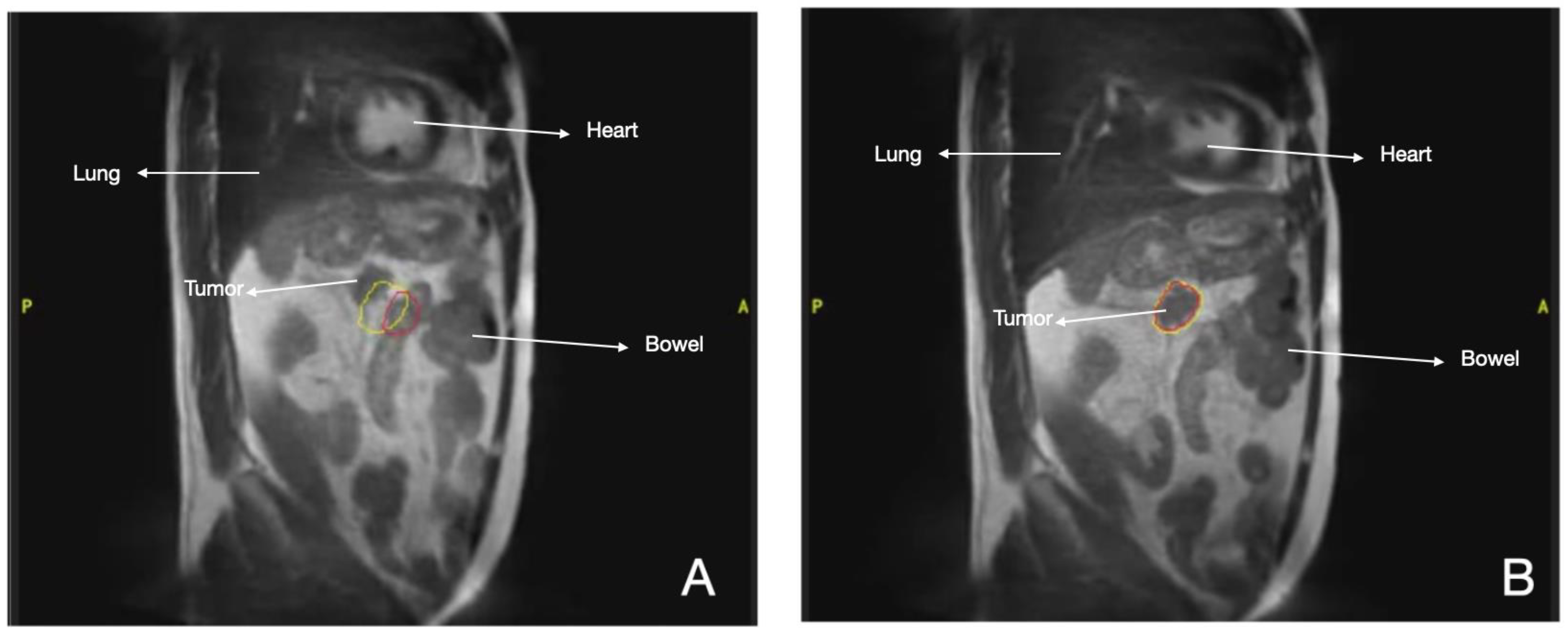 MR-LINAC, a New Partner in Radiation Oncology: Current Landscape