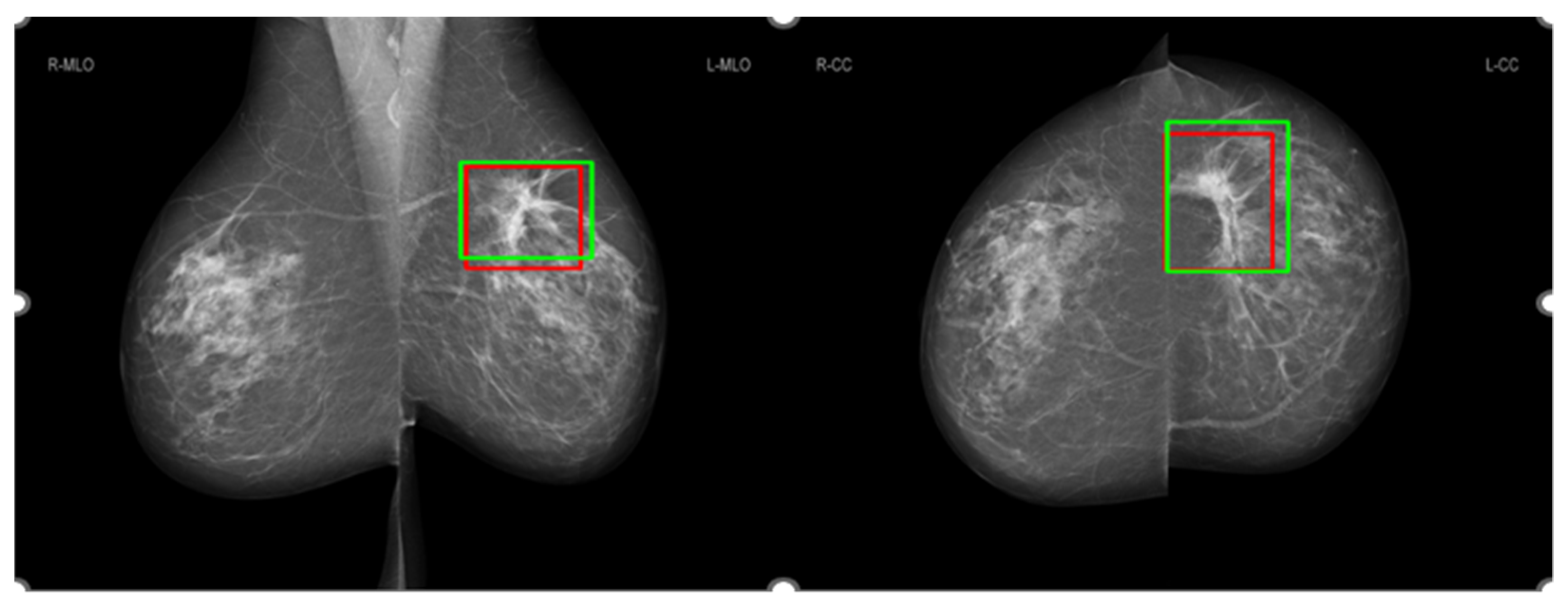 Evaluating Recalibrating AI Models for Breast Cancer Diagnosis in a New ...