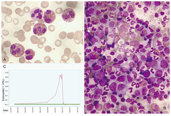 Hematological Neoplasms with Eosinophilia