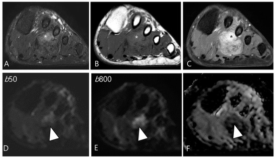 Diffuse-Type Tenosynovial Giant Cell Tumor: What Are the Important ...