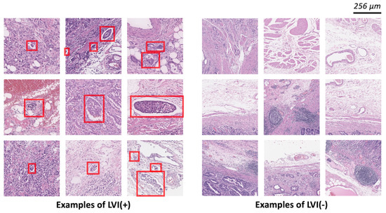 Ensemble Deep Learning Model to Predict Lymphovascular Invasion in ...